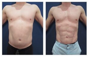 Abdominal Etching | High Definition Liposuction