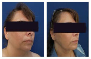 The ultimate guide to chin neck contouring with HD Liposuction